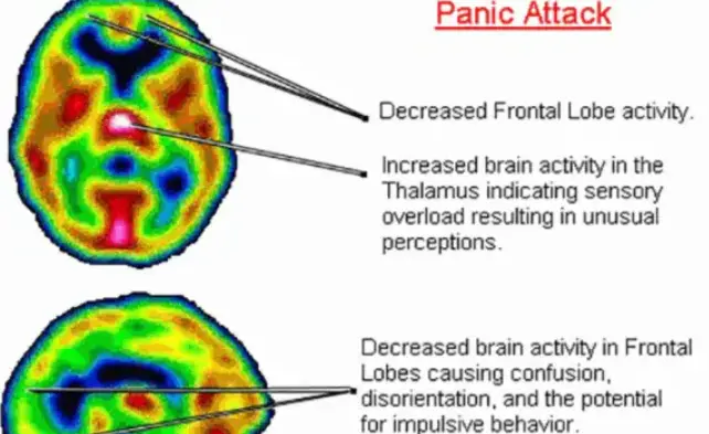 Low Levels of Vitamin B and Iron Could Lead to Anxiety and Panic Attacks